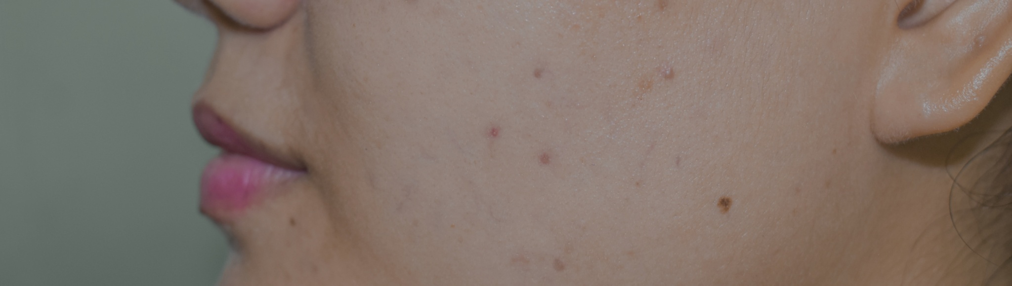 Hyperpigmentation et melasma - Cleo Bordeaux