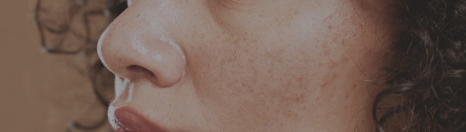 Lentigos - Cleo Bordeaux