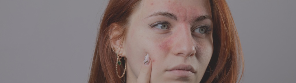 Erythrose et Couperose - Cleo Bordeaux