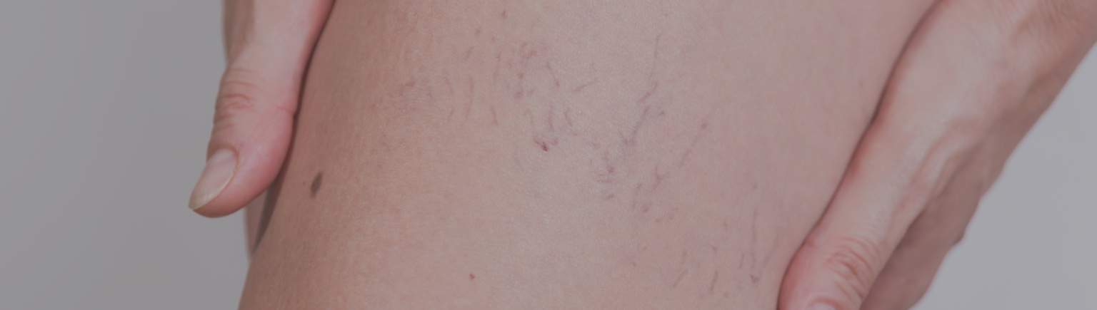 Varicosités et Telengiectasies - Cleo Bordeaux